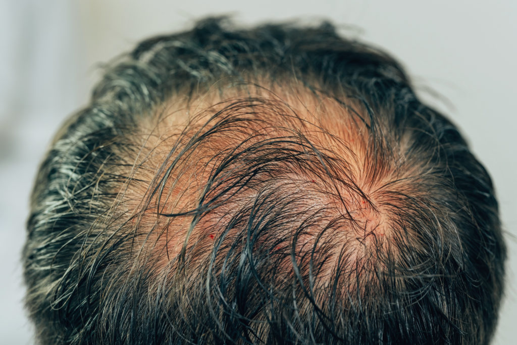 Male pattern baldness: Can it be stopped? | Bio Hair Clinic
