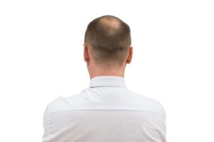 Diffuser Haarausfall- Wie lässt sich der Haarschwund aufhalten?