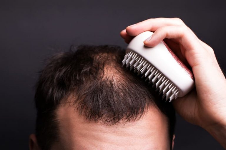 Erste Schritte bei Haarausfall: Was sollte man dagegen tun?