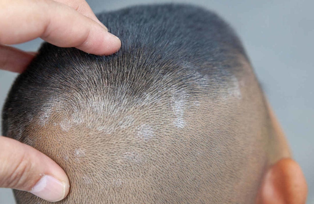Infektionen nach Haartransplantation verhindern I Bio Hair Clinic